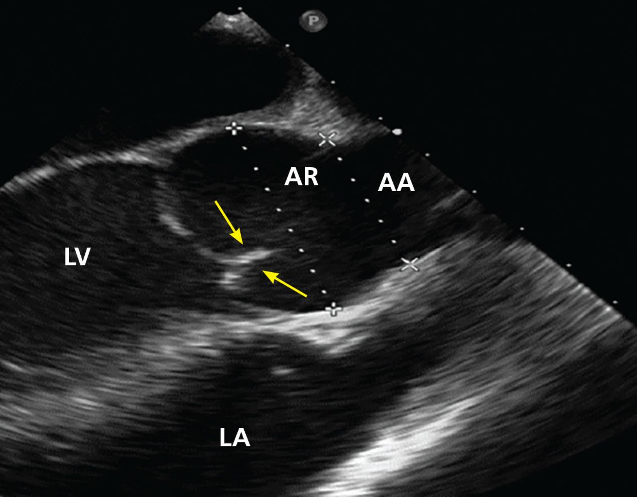 Bicuspid Aortic Valve Basics And Beyond Cleveland Clinic Journal Of