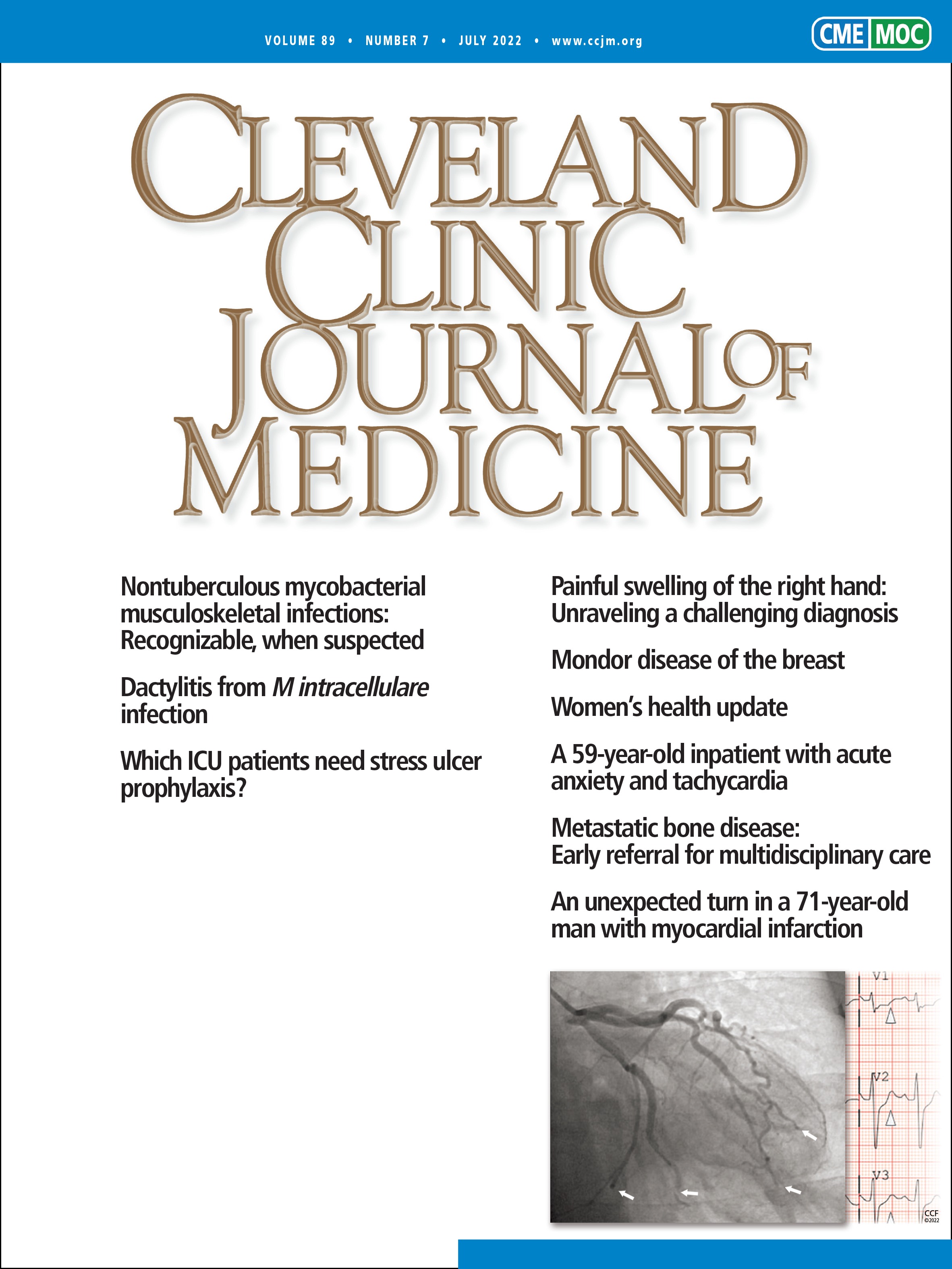 Dactylitis from Mycobacterium intracellulare infection | Cleveland ...
