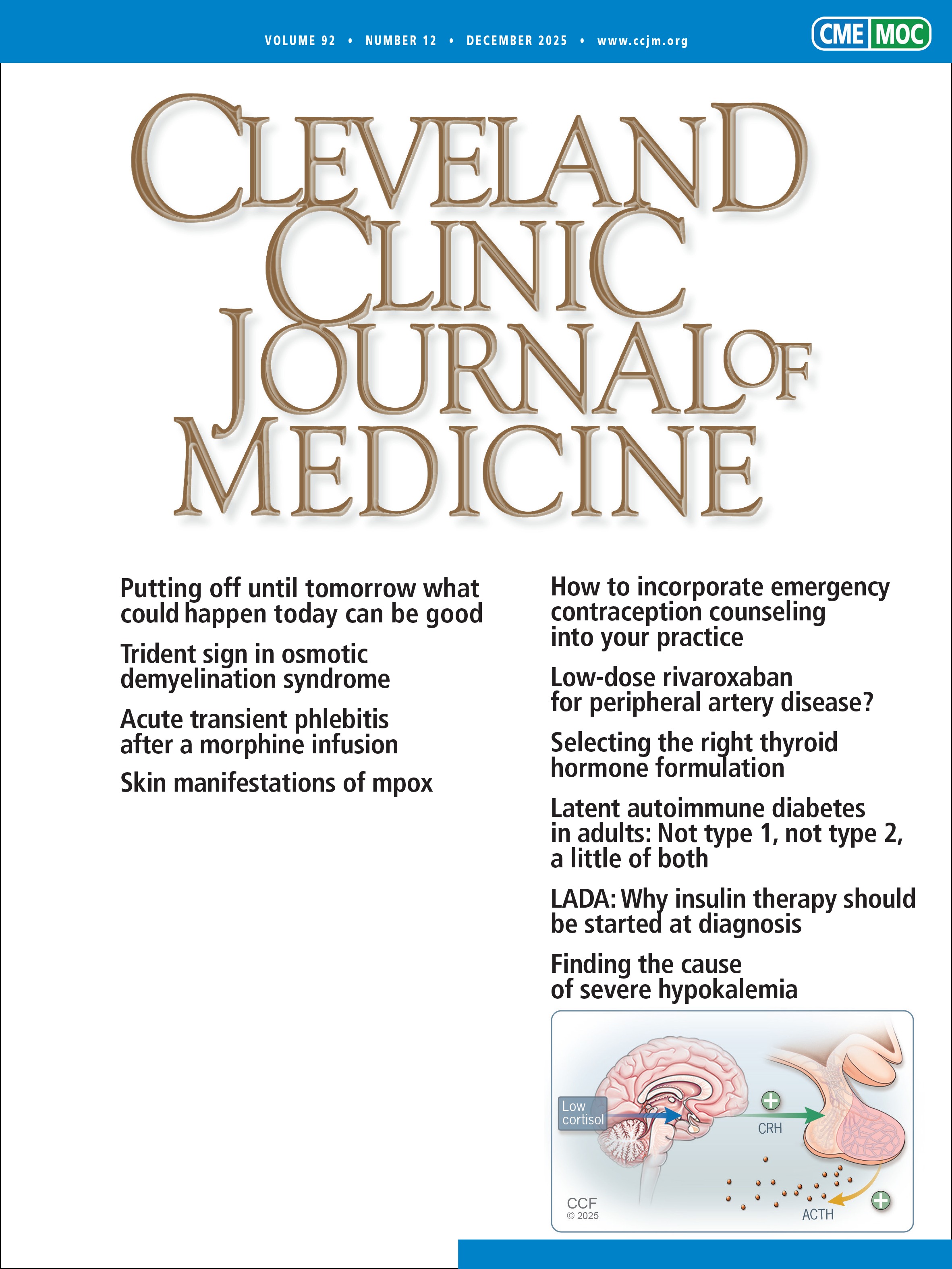 Trident sign in osmotic demyelination syndrome | Cleveland Clinic ...